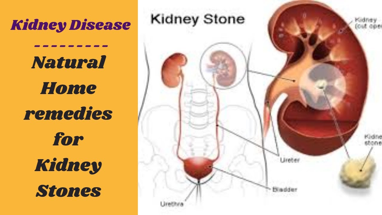 Home Remedies for Kidney Stones - Natural Home Remedies that Can Help ...