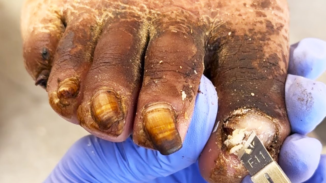 Dirty toenails, remove the hidden black dirtDoctor Liu Pedicure - YouTube