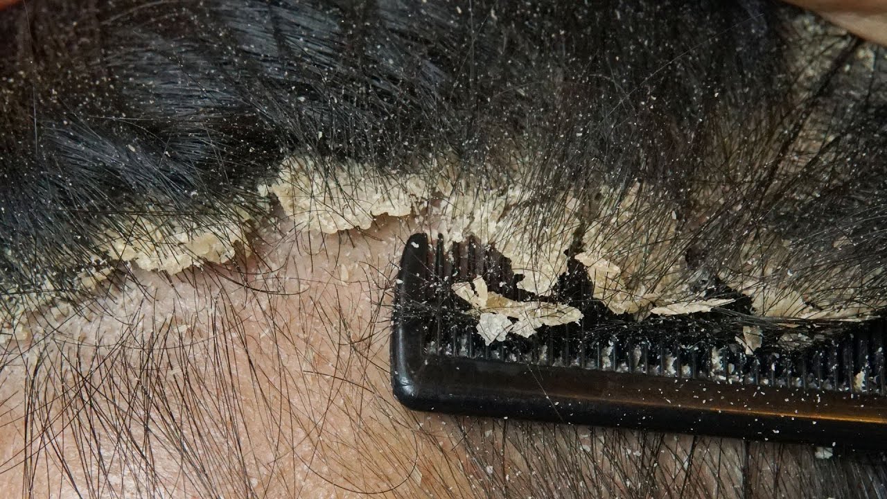 Satisfying Dandruff Cleaning, Hand & Brush for Ultimate Relaxation # ...