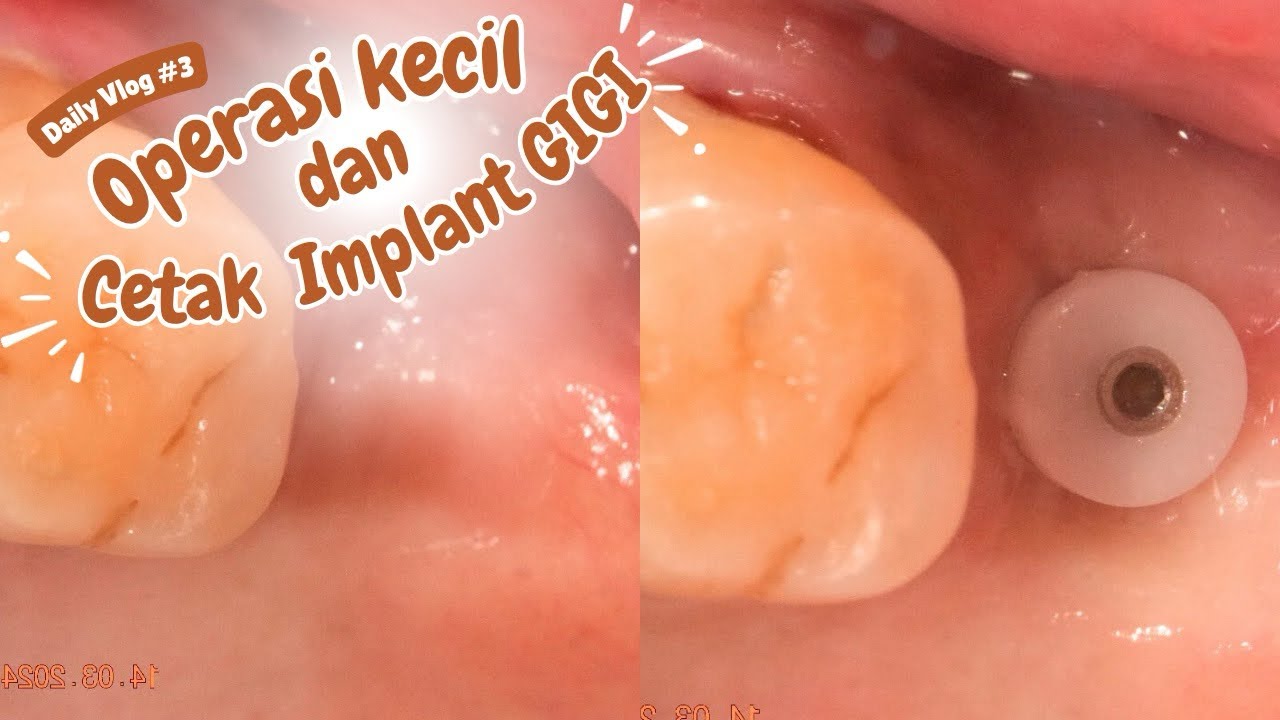 Operasi Kecil dan Cetak Implant Gigi, Ikutin Keseruan di Arirang Dental ...