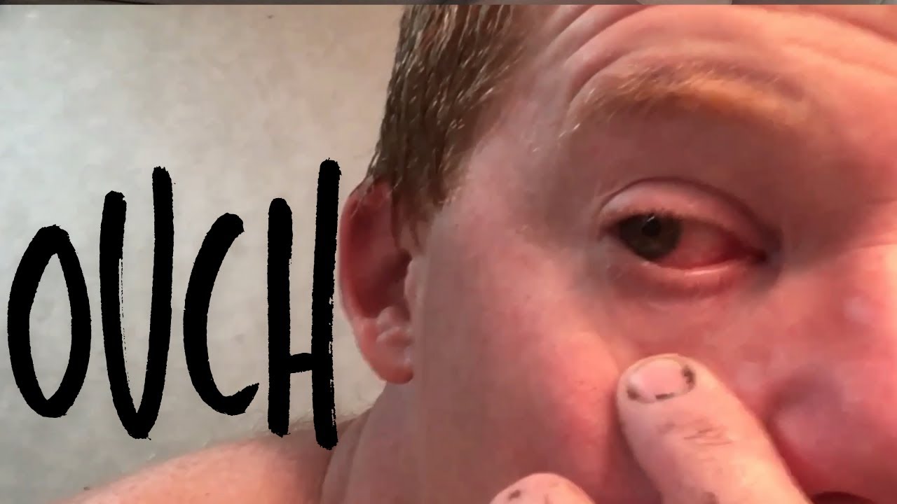 EYE PUNCHED - YouTube