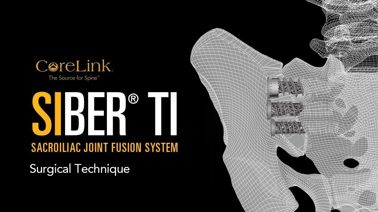 CoreLink Siber Ti Sacroiliac Joint Fusion System Procedure - YouTube