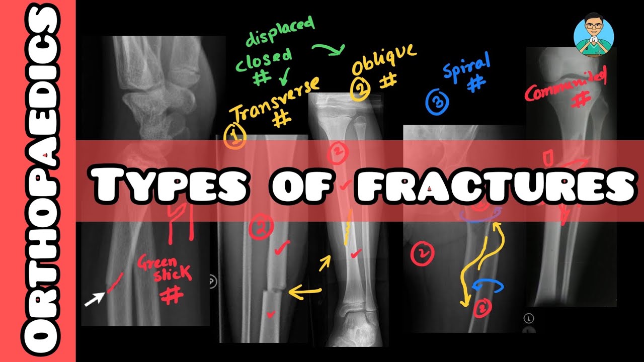 Types of Fractures for USMLE - YouTube