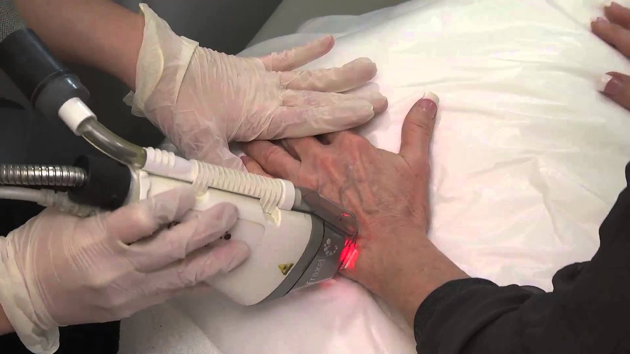 Fraxel On the Hands - YouTube
