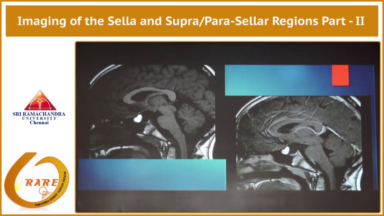 Imaging of the Sella and Supra/Para-Sellar Regions Part - II - YouTube
