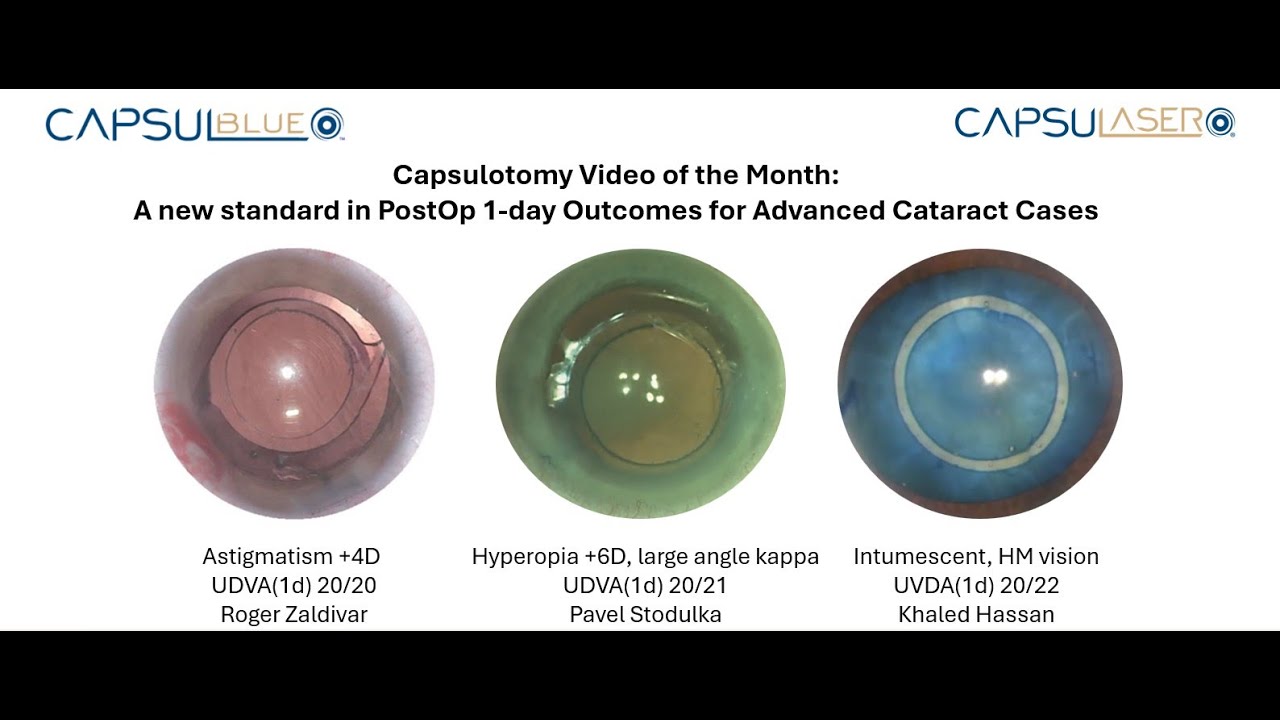 Capsulotomy Video of the Month: PostOp 1d Outcomes in Advanced Cataract ...