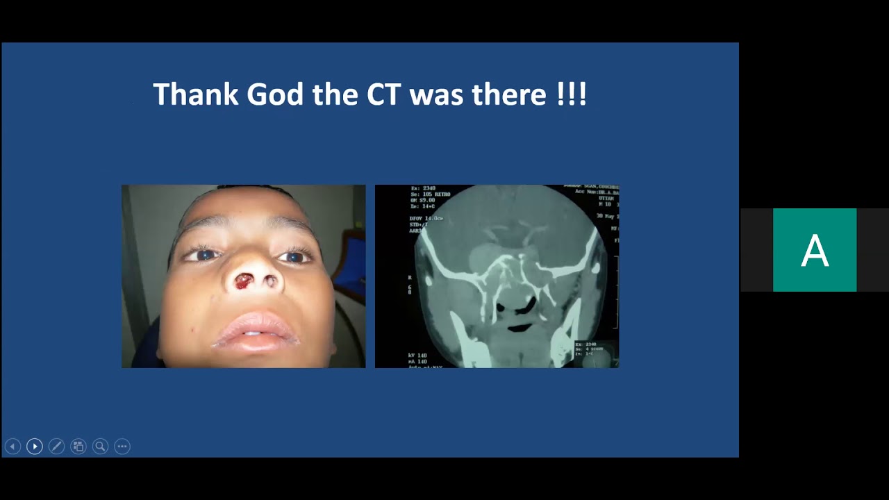 ENT Grand Rounds Part 1: Epistaxis. - YouTube