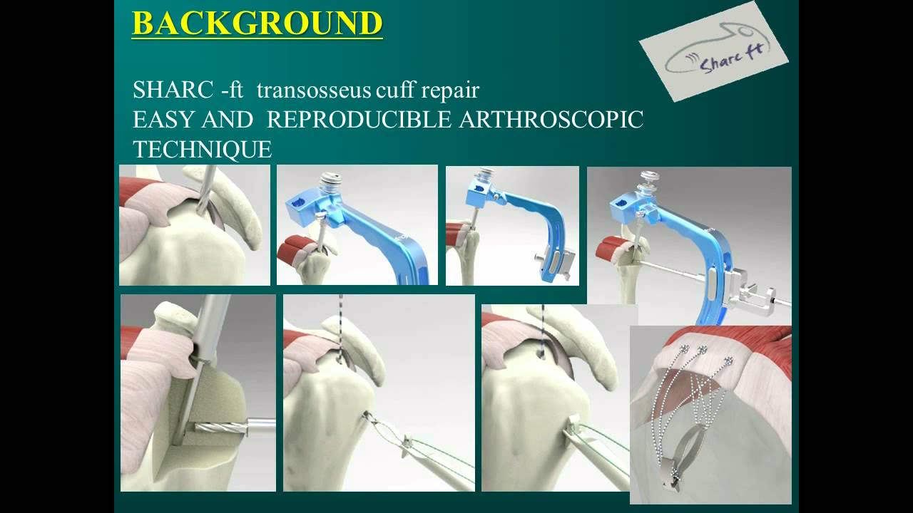 Presentation of Sharc-FT system at AANA 2013 Annual Meeting - YouTube