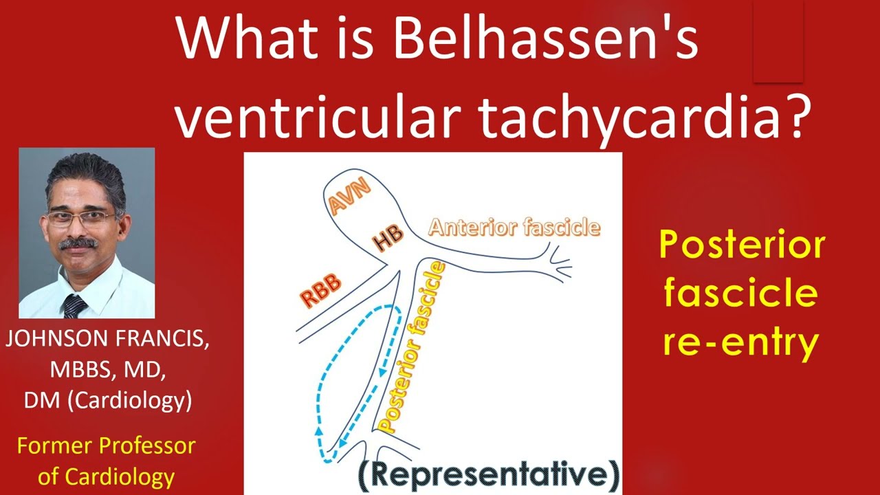 What is Belhassen's ventricular tachycardia? - YouTube