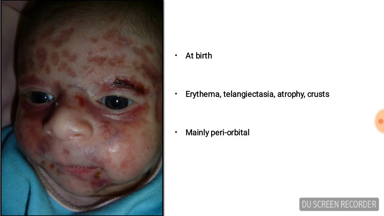 Dermatoses of pregnancy Part 3 - YouTube