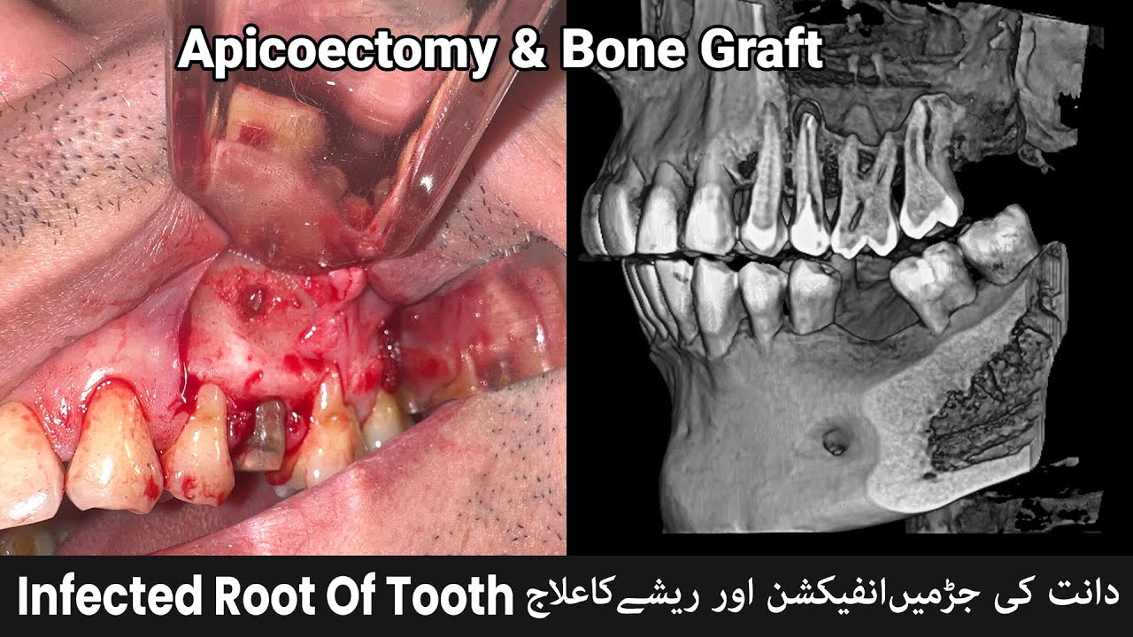 Infected Root Treatment Of Tooth with Apicoectomy Surgery | Live Procedure Video | RCT Infection ...