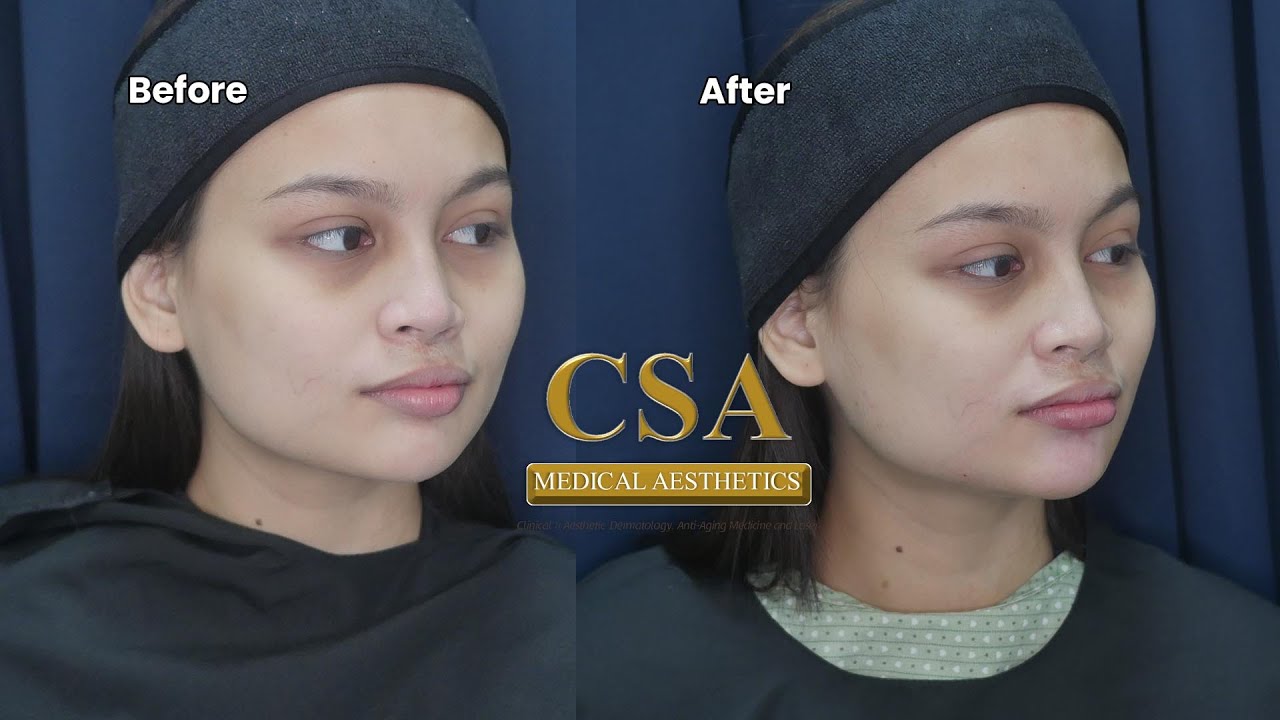 HOW TO TREAT SHORT CHIN - YouTube