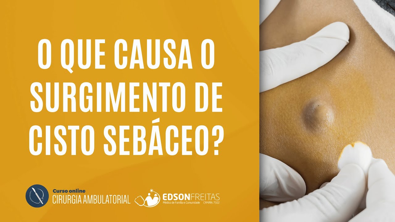 O que causa o surgimento do cisto sebáceo? - YouTube