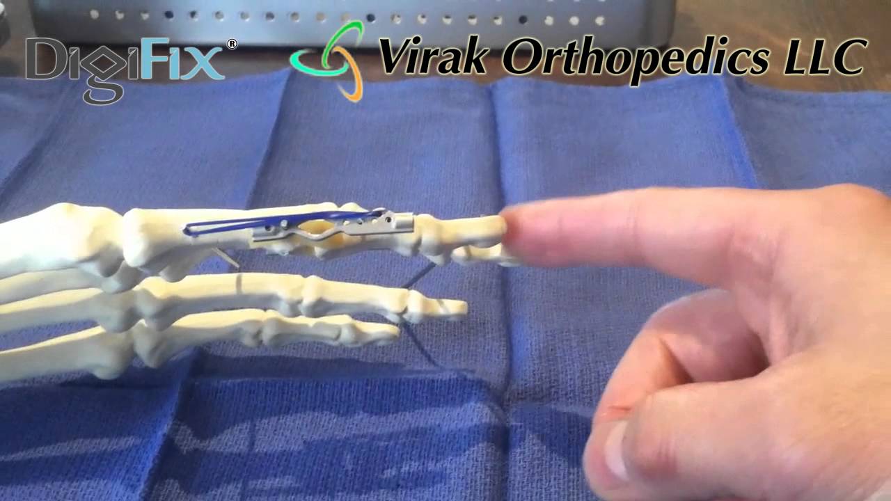 DigiFix® Use With Elastomer For Passive PIP Extension and Flexion - YouTube
