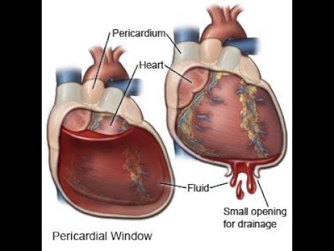 Pericardial Window Surgical procedure ; Definition, indications ...