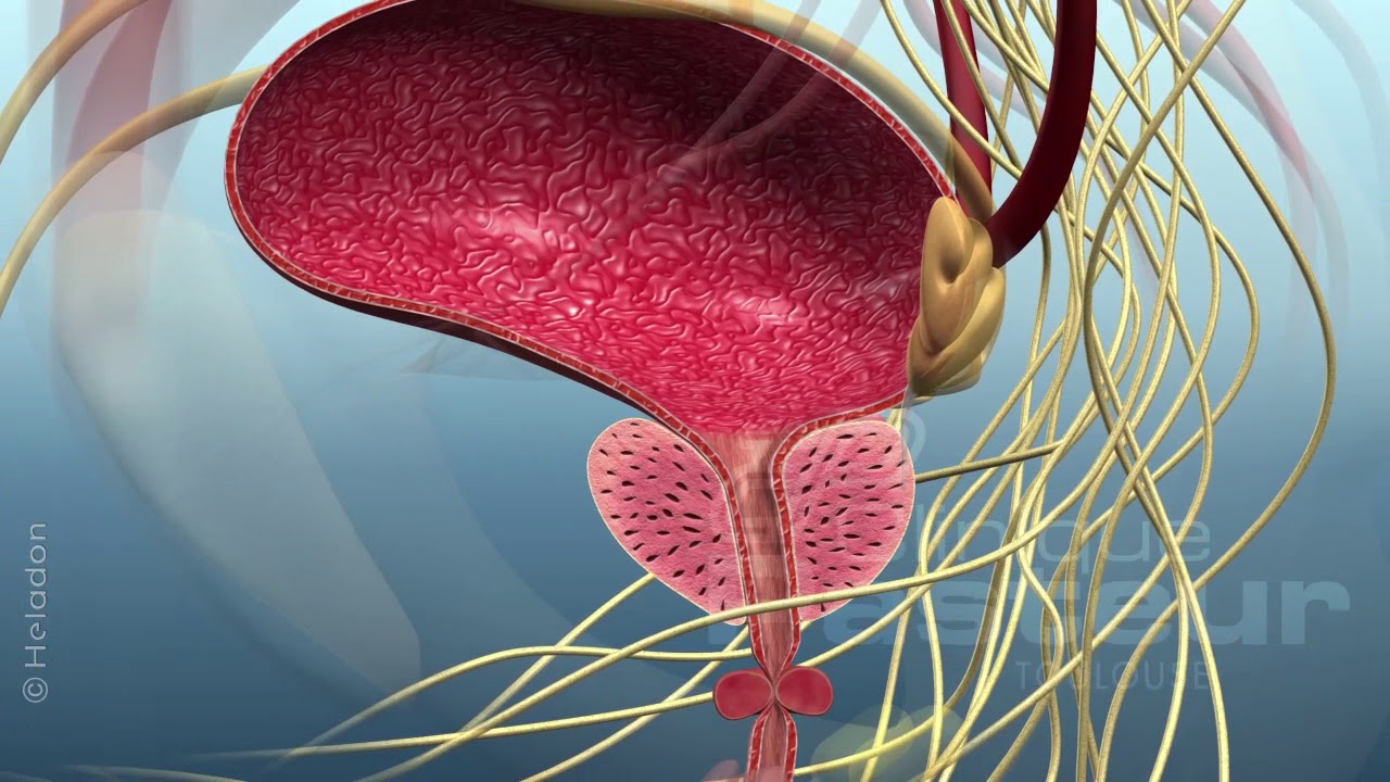 PROSTATE cancer PATHO - YouTube