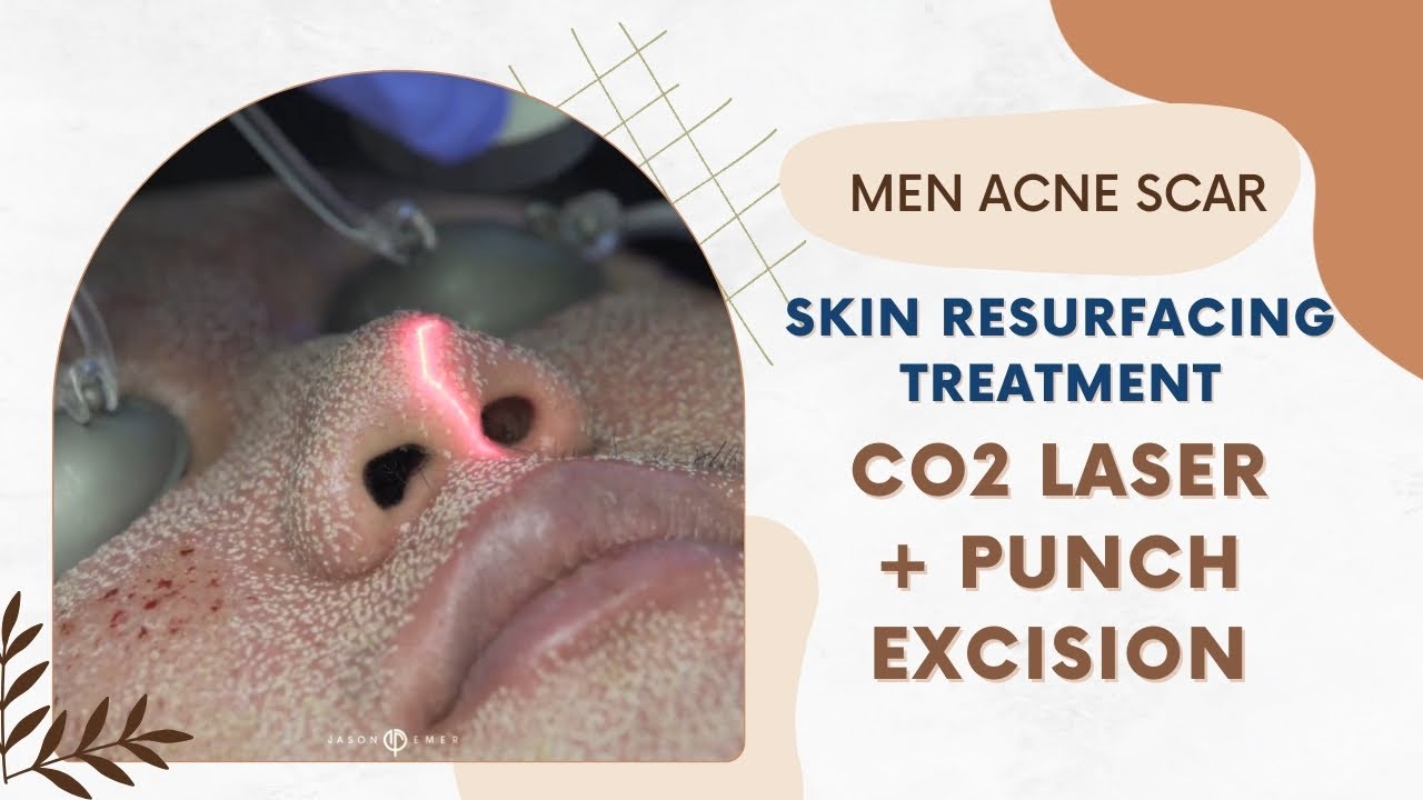 Men Acne Scar Skin Resurfacing Treatment CO2 Laser + Punch Excision ...