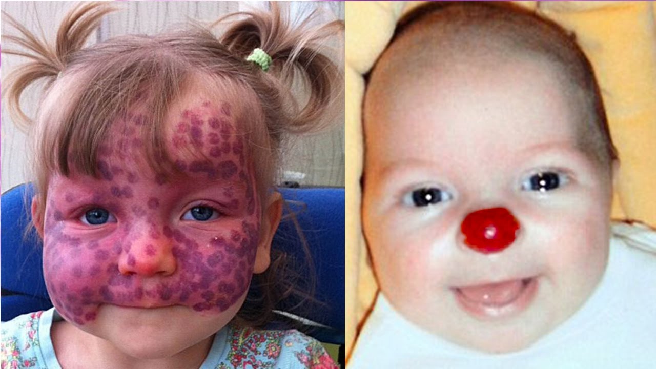 Las 6 Marcas de Nacimiento más raras del mundo - YouTube