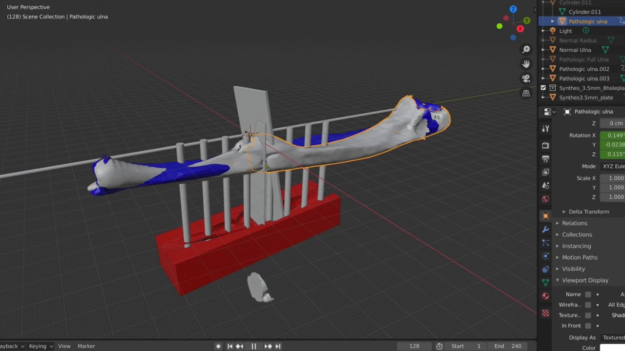 All in one animation: correction of deformity, application of plate and ...