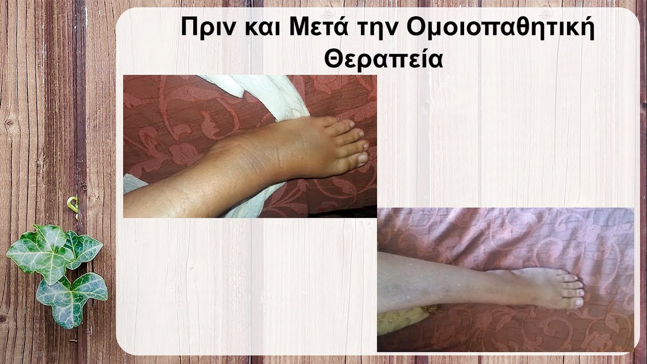 Ομοιοπαθητική και Κατάγματα Οστών: Περιστατικό 15 - YouTube