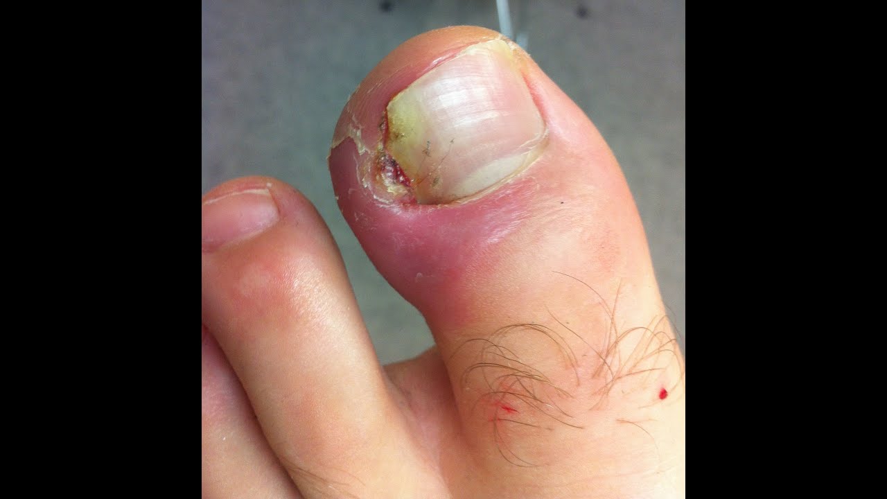 Finger fungus. Toenail fungus remedy. Fingernail fungus treatment ...