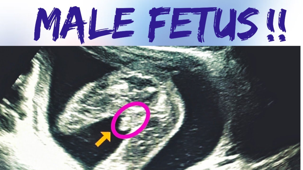 Male Fetus Gender Identification Scan Fetal Sex Determination 2nd Trimester Scan Youtube