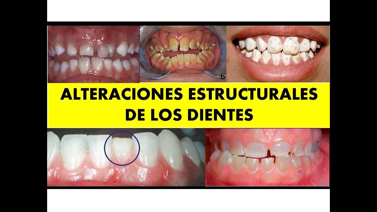 "ALTERACIONES ESTRUCTURALES DE LOS DIENTES" - YouTube