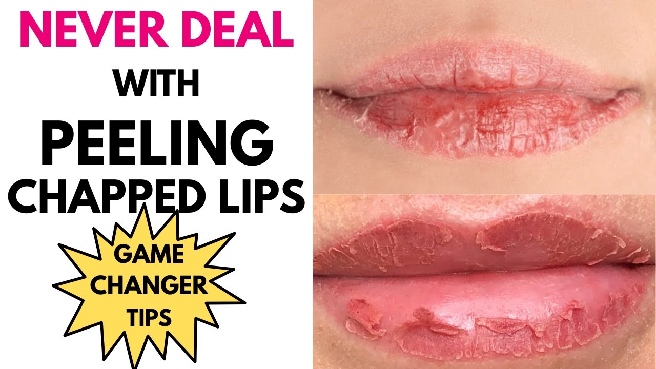 NEVER DEAL with Peeling CHAPPED Lips #chappedlips #goseechristy - YouTube