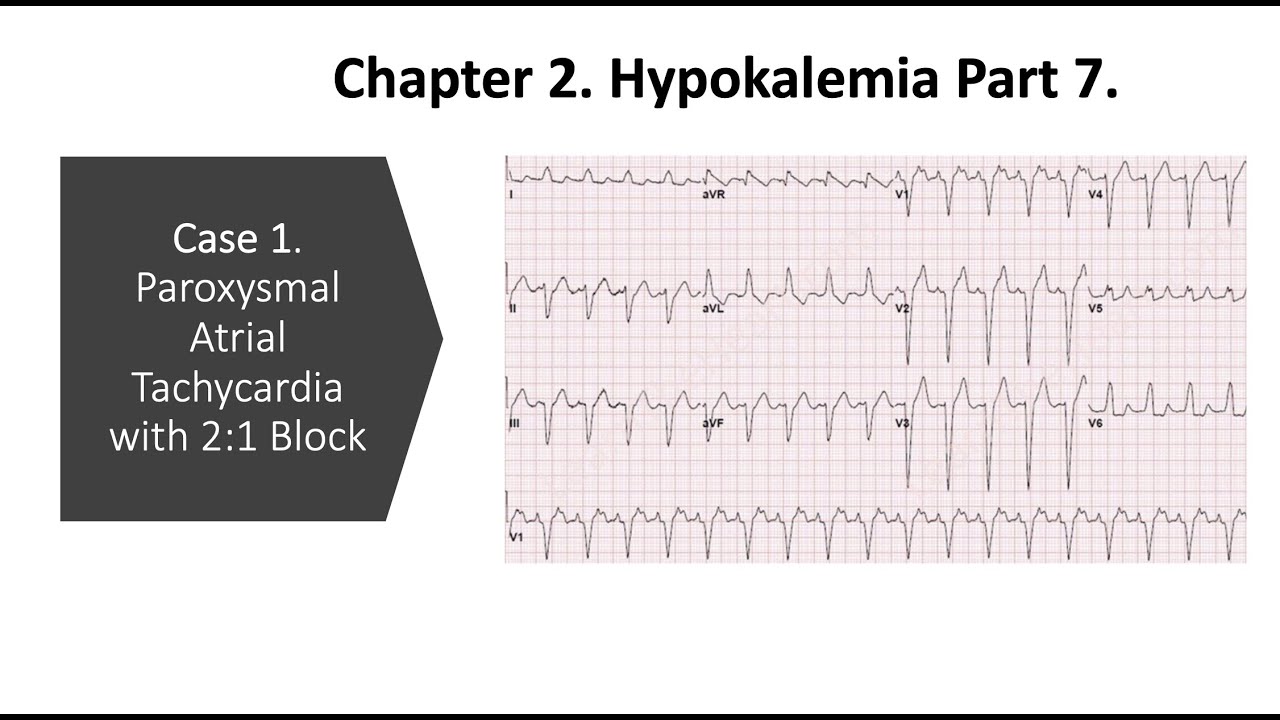 Hypokalemia Part 7. Management of Hypokalemia - YouTube