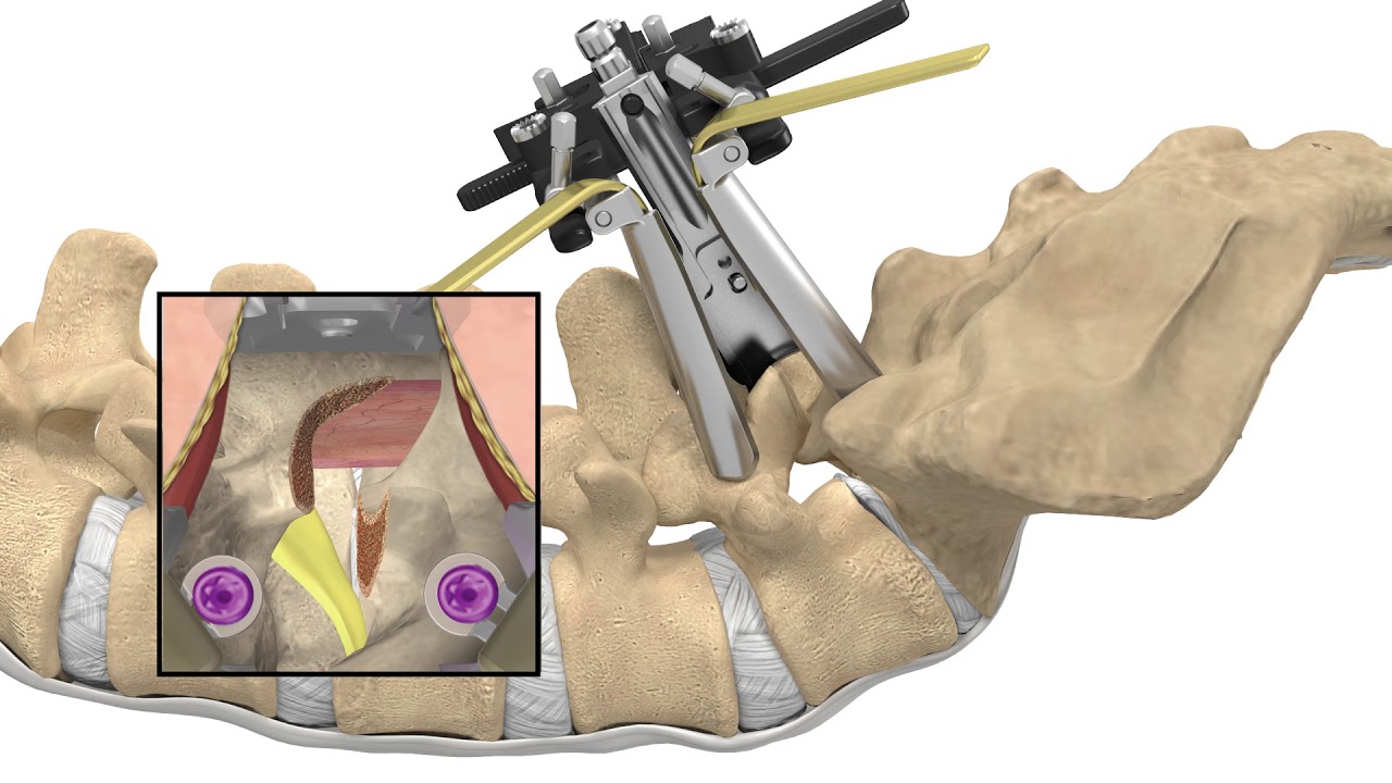 MAS TLIF Patient Education Animation Spanish - YouTube