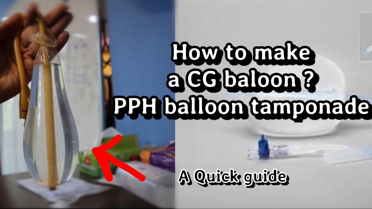 How to make a Chhattisgarh (CG) balloon - Management of Postpartum ...