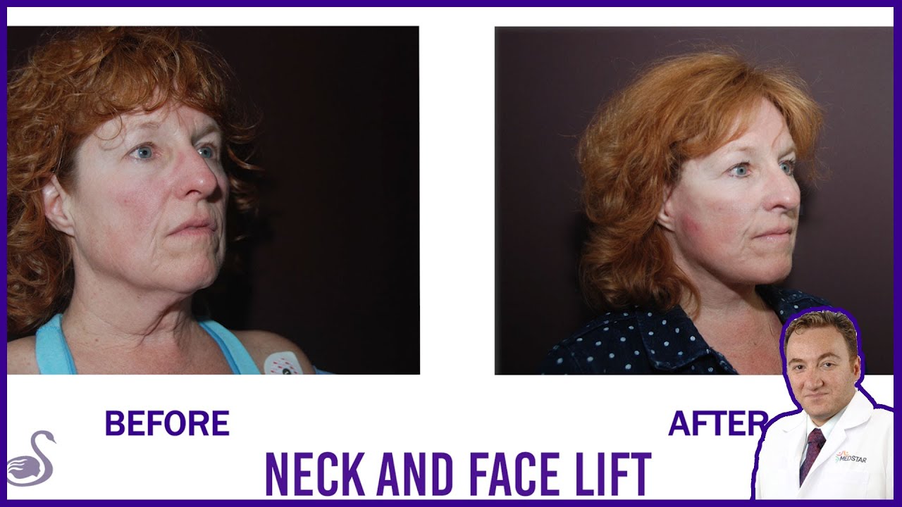 Best Neck and Facelift Surgeon Dr Payman Simoni Beverly Hills - YouTube