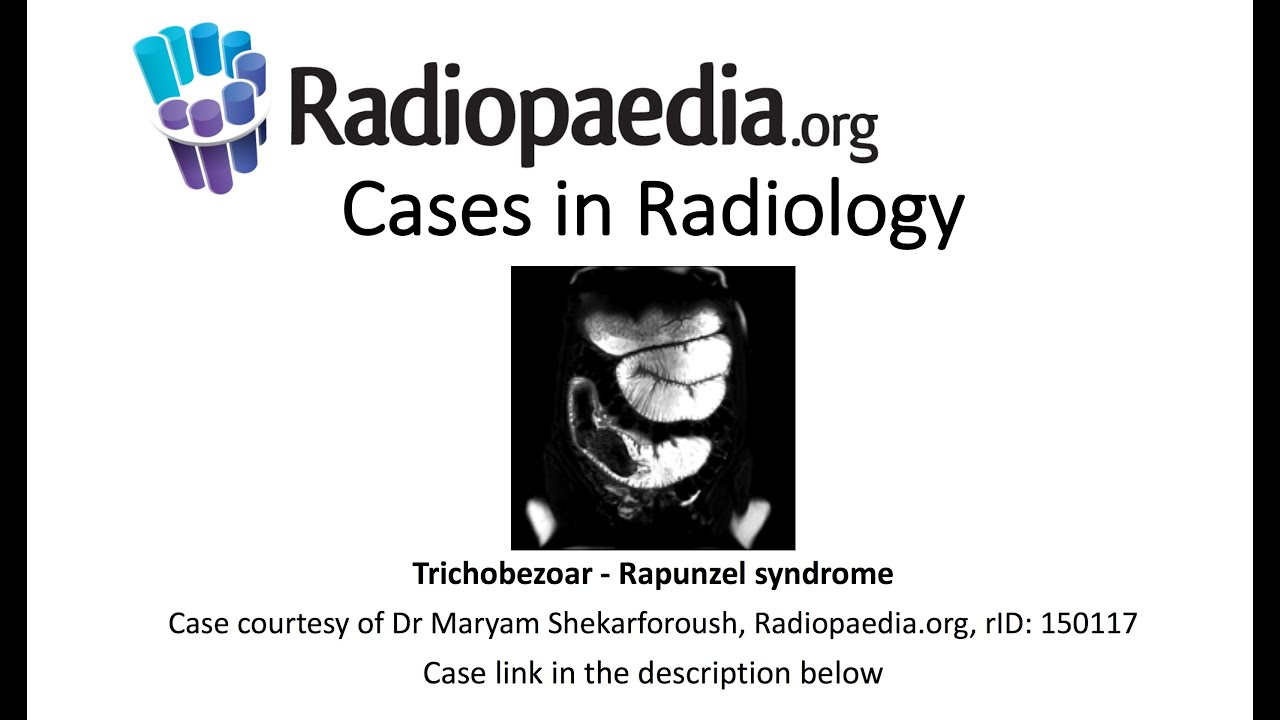 Trichobezoar - Rapunzel syndrome (Radiopaedia.org) Cases in Radiology ...