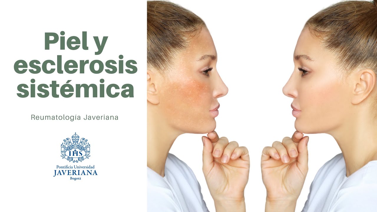 Piel y esclerosis sistémica - YouTube