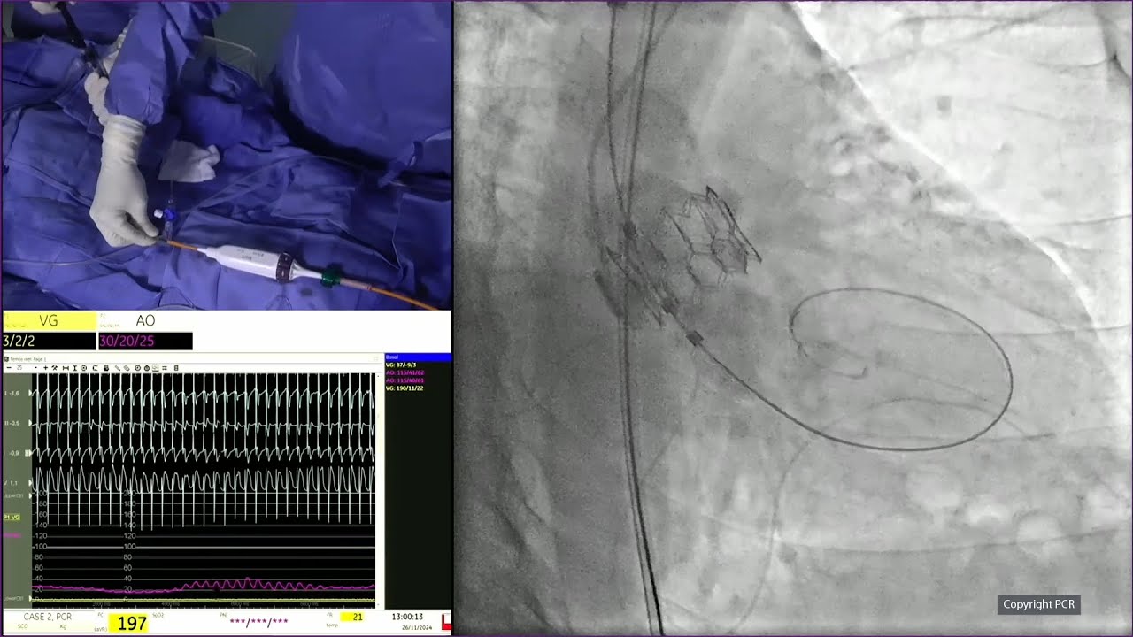 Align for the future with the novel balloon expandable Myval ...