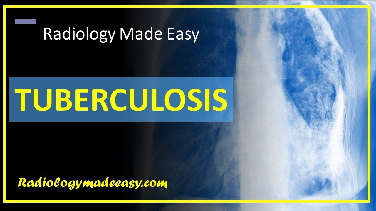 Radiological features of TUBERCULOSIS - YouTube
