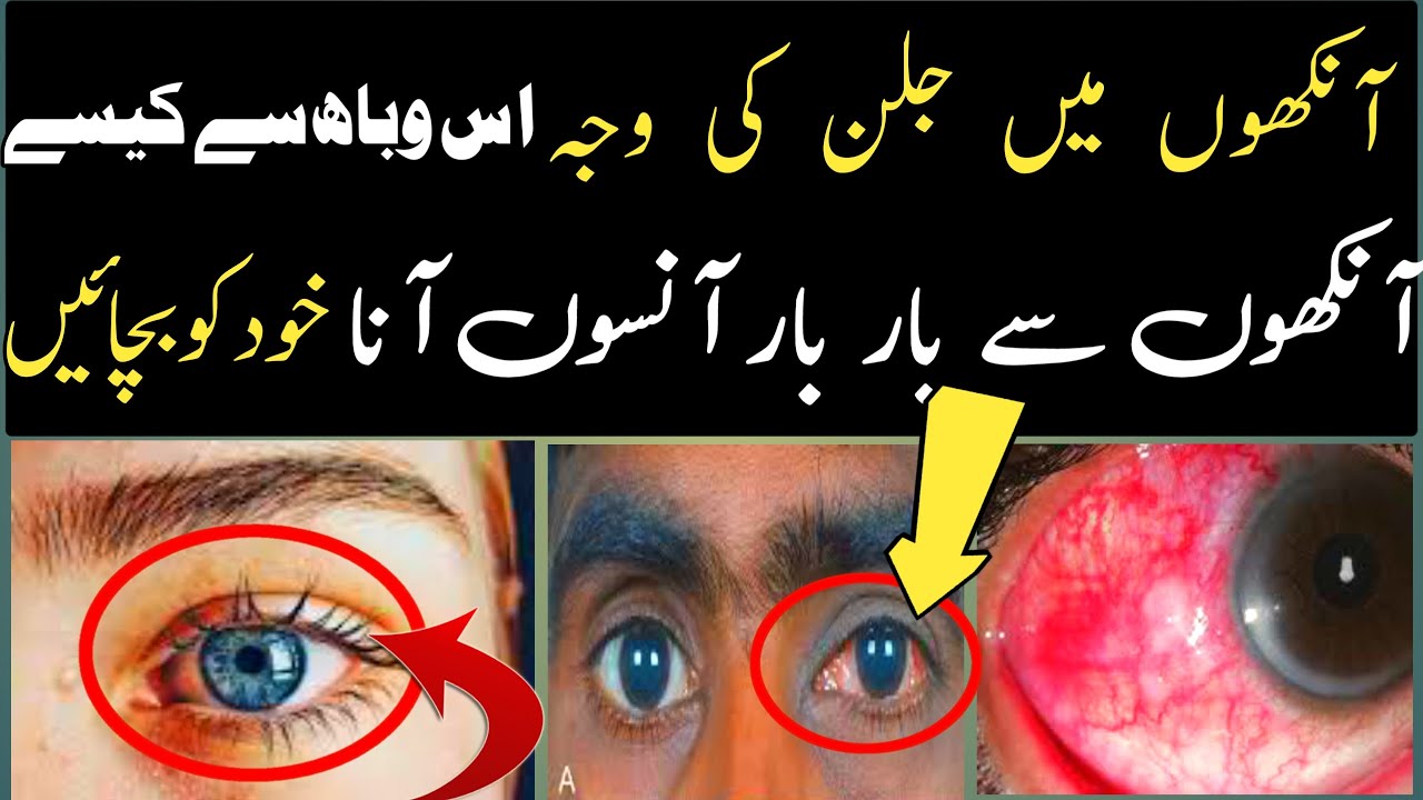 Karachi Eyes Infection Case|conjunctivitis Eyes Infection|2023 Big Case ...