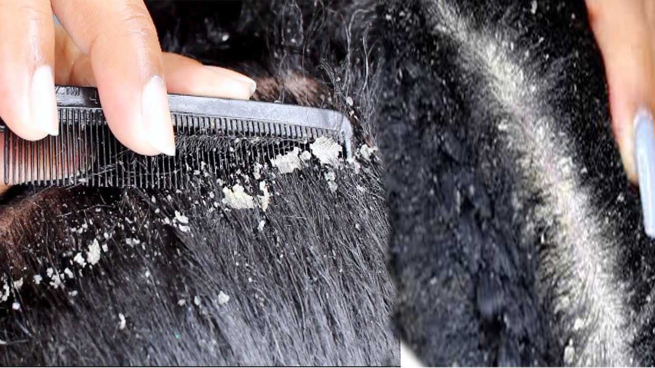 Dry Flaky Scalp Dandruff Scratching Picking Combing Big Flakes HUGE ...