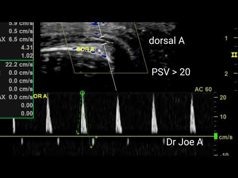 Normal penile Doppler ultrasound in erectile dysfunction. Without penile injection of papavarine.