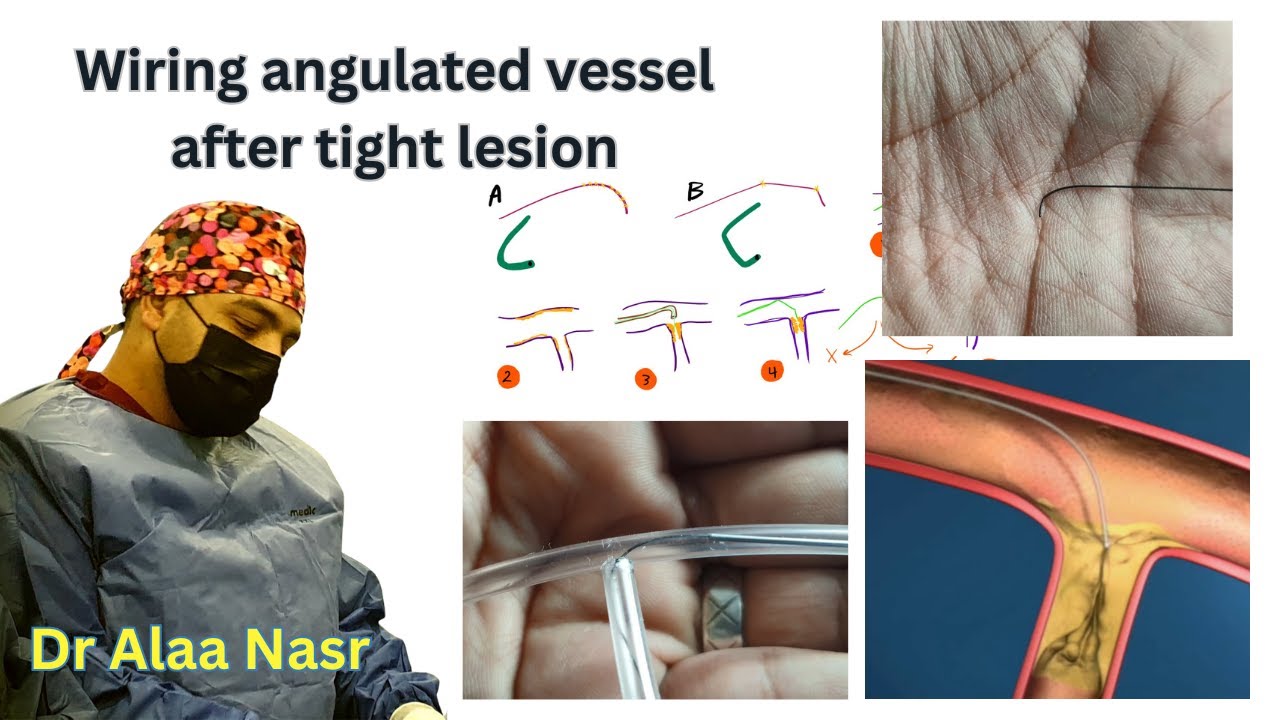 Coronary wiring tips and tricks ( angulated vessel after tight lesion ...