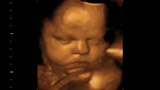 3d Ultrasound At 28 Weeks