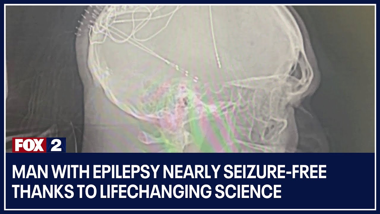 Man with epilepsy nearly seizure-free thanks to lifechanging science ...