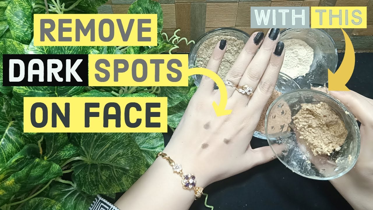 How To Remove "Dark Spots" Caused By Pimples (Cure Black Dots On Face ...