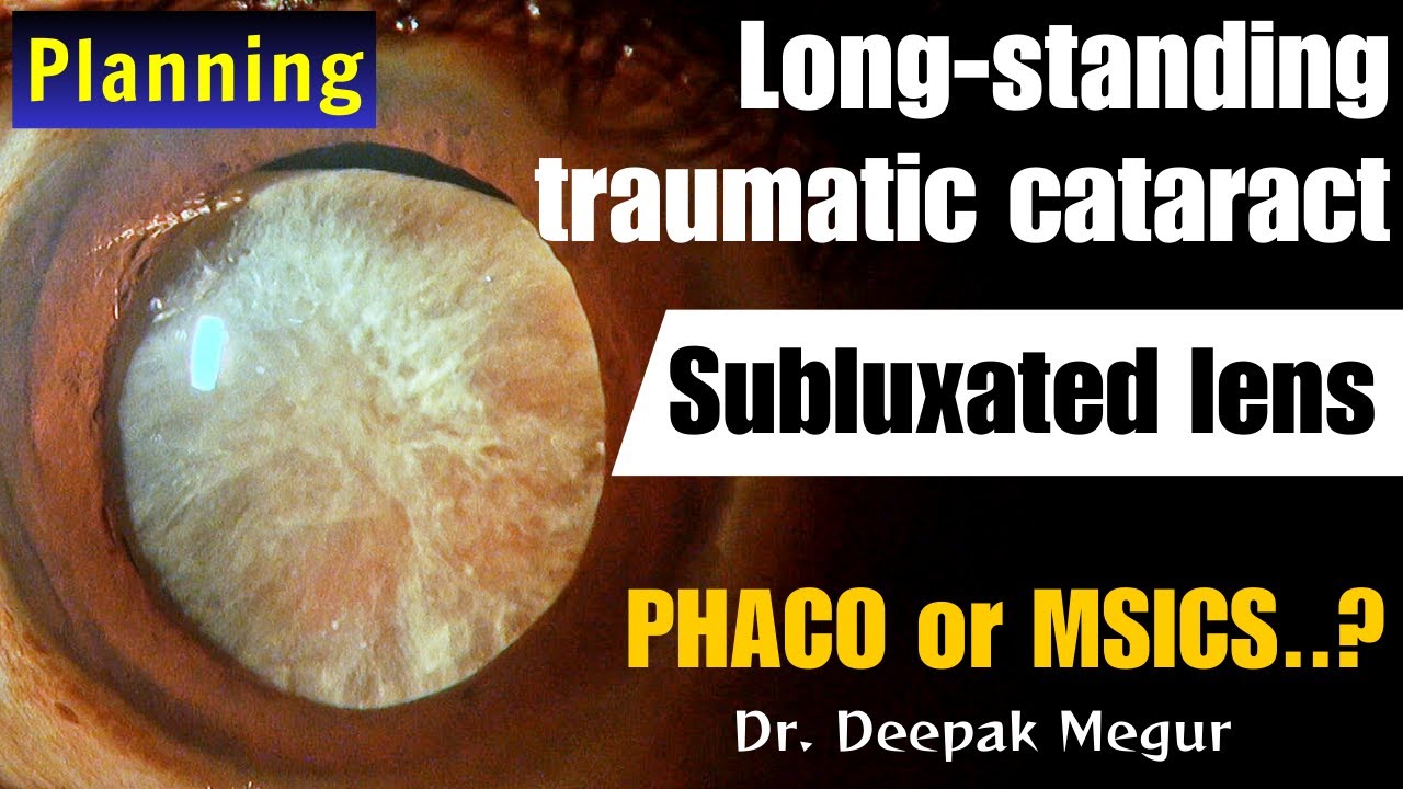 Longstanding hypermature subluxated cataract : Planning - Dr. Deepak ...