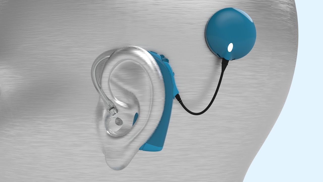 ADVANCED BIONICS COCHLEAR SYSTEM | PULSE DESIGN GROUP - YouTube