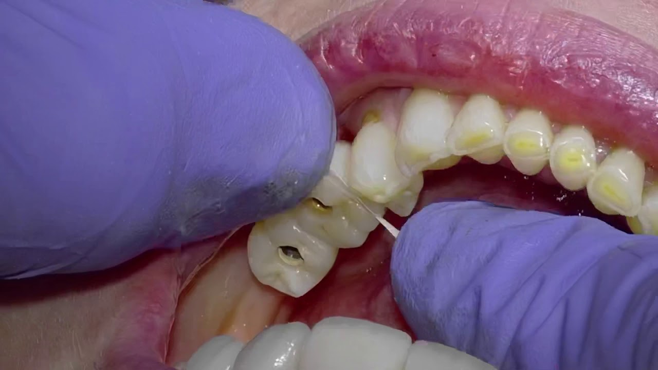 Fitting screwed in dental implant crowns - YouTube