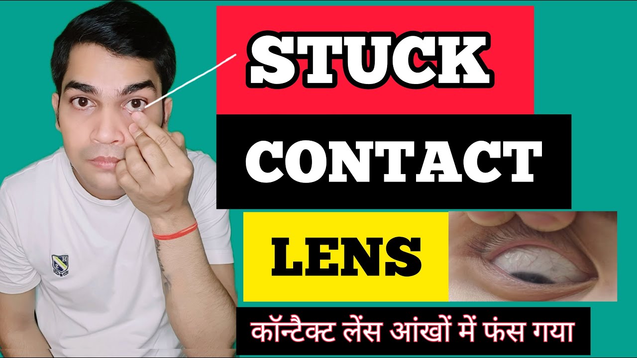 How to Remove a Contact Lens Stuck in Your Eye - EASY steps- कैसे ...
