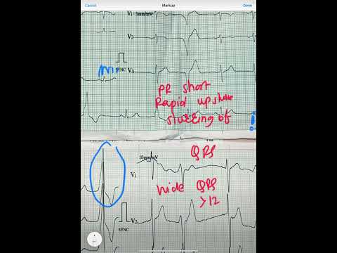 Can Wolff Parkinson White Be Intermittent