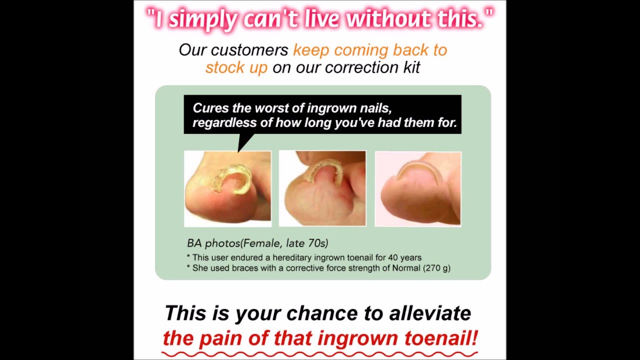 This method of fixing an ingrown toenail is both genius and disgusting ...