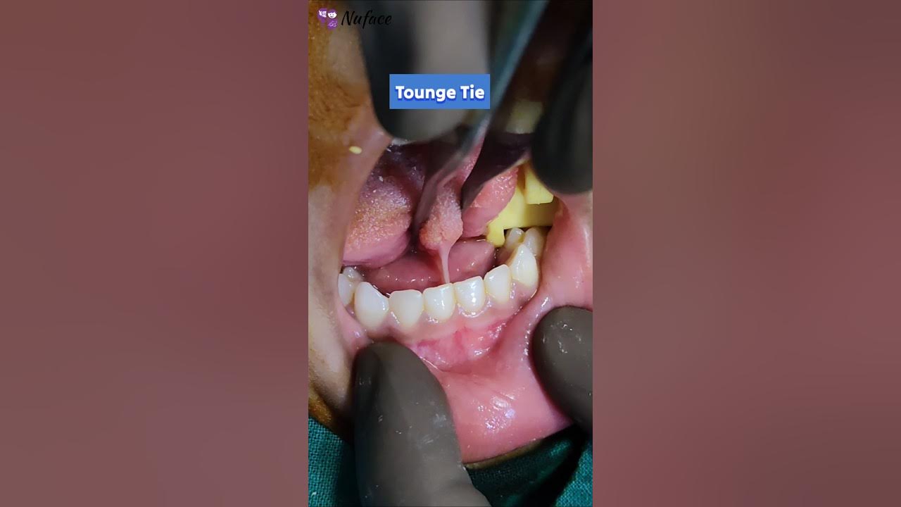 Tongue Tie Release Surgery | Ankyloglossia | Frenotomy | Dr Parit Ladani - YouTube